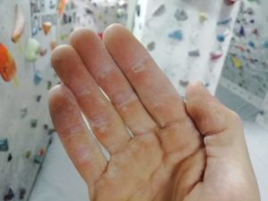 Rock Climbing Hand Care: How to Take Care of Your Callus
